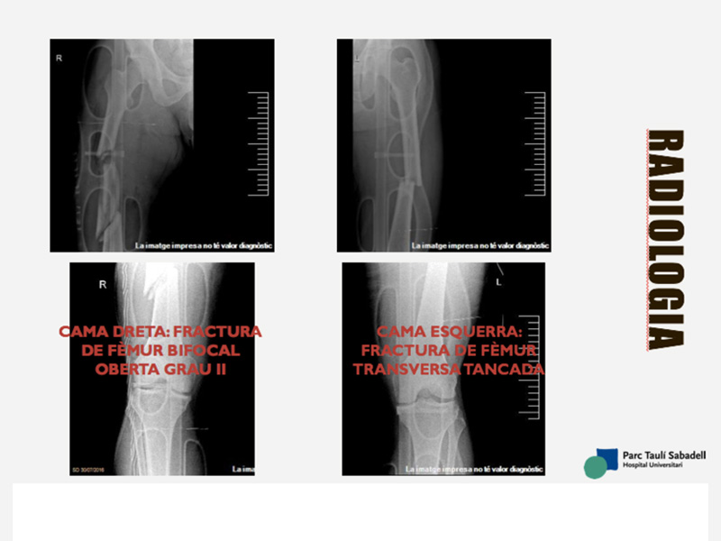 COT CAT | Fractura de Fémur Bilateral